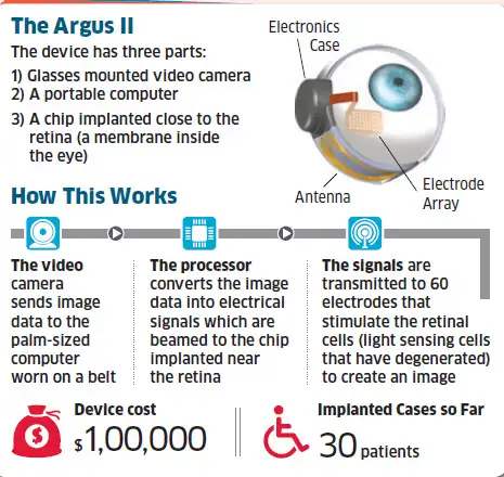 Argus II: How bionic device Argus II helps restore sight to the blind ...