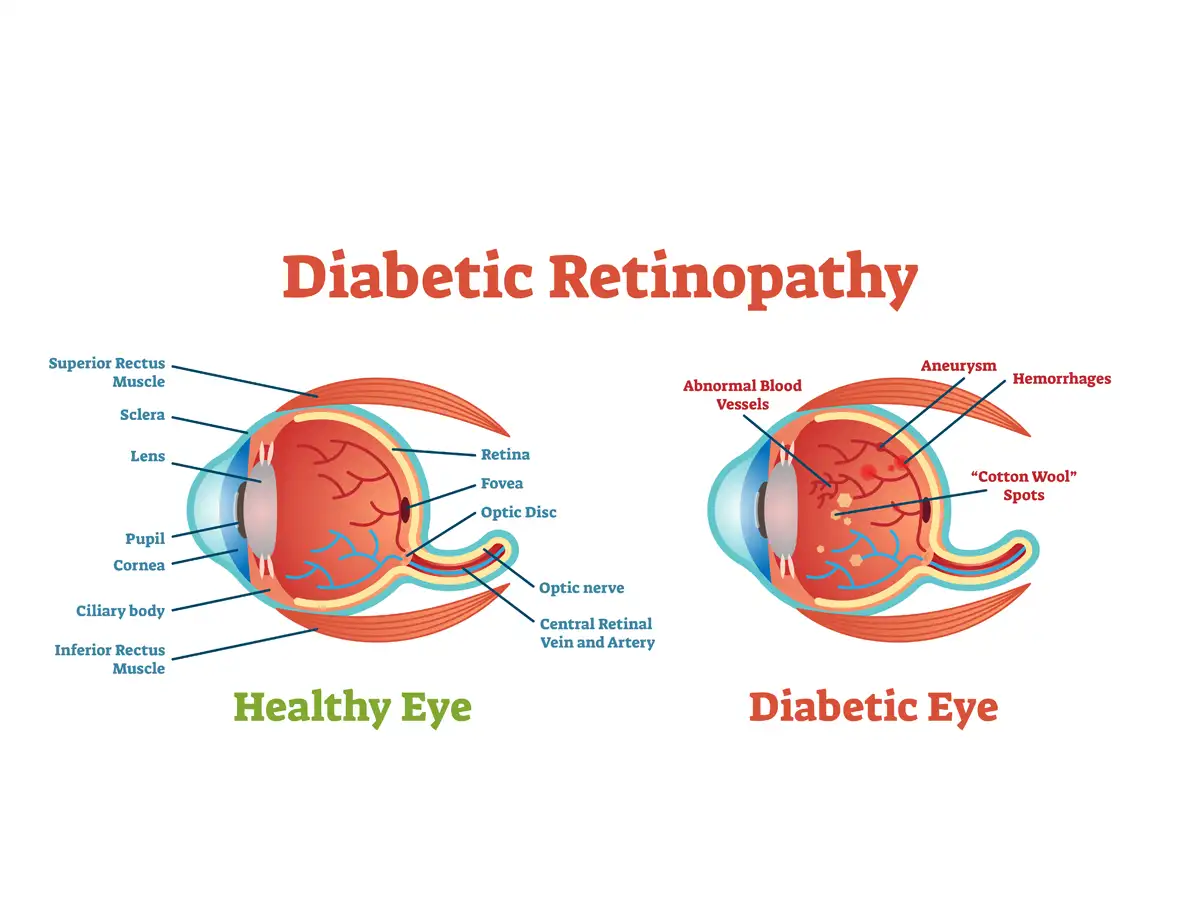 diabetic: Do you experience flashes of light, distortion of images ...