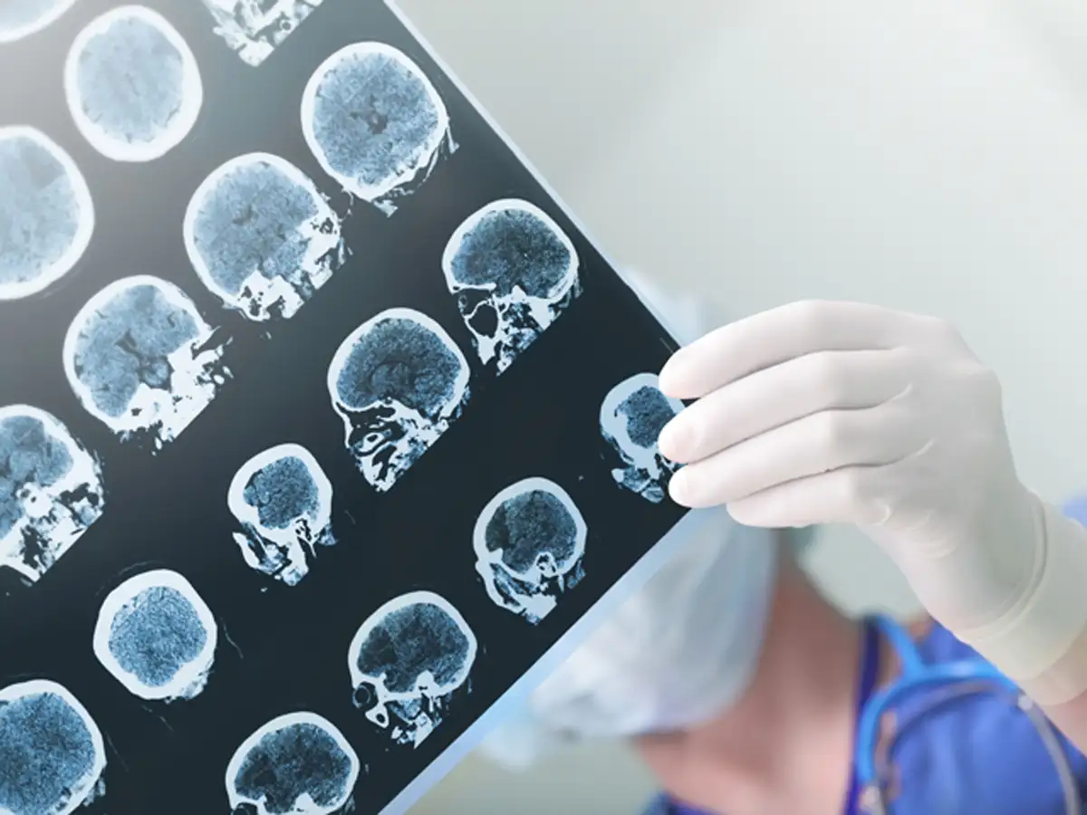cerebral ischemia: New device can quickly detect stroke, monitor poor ...