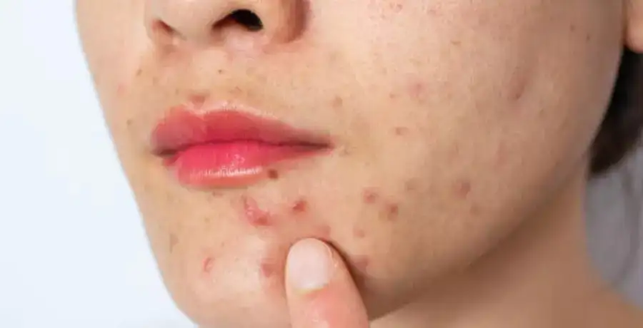 treat body acne: Ways to treat body acne | EconomicTimes