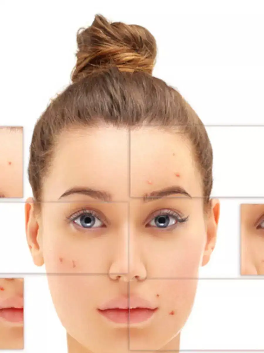 Say goodbye to pimple marks: 7 home remedies you need to try ...