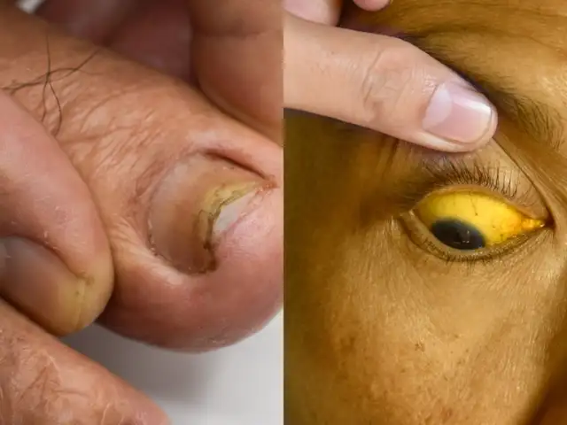Liver damage: 7 signs that show up on your hands and feet - Liver ...