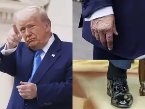 Trump health news: Trump health buzz: Strange bruises, stroke rumors ...
