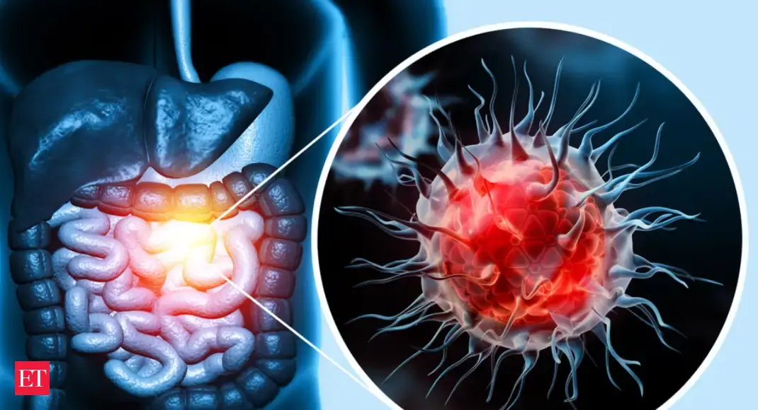 "Colon cancer risk rising in young adults": 4 causes and 4 essential ...