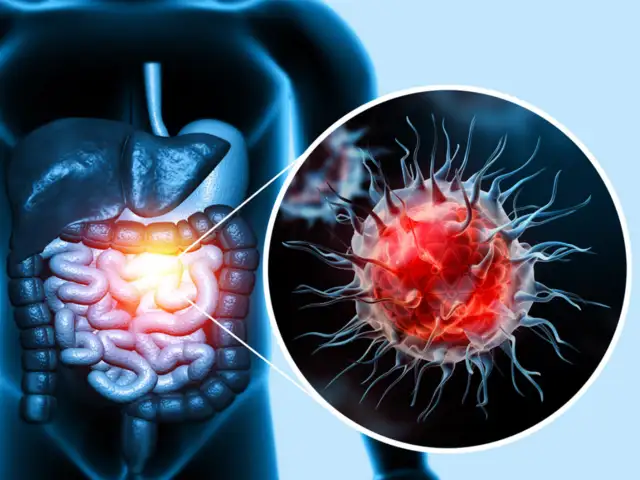 "Colon cancer risk rising in young adults": 4 causes and 4 essential ...