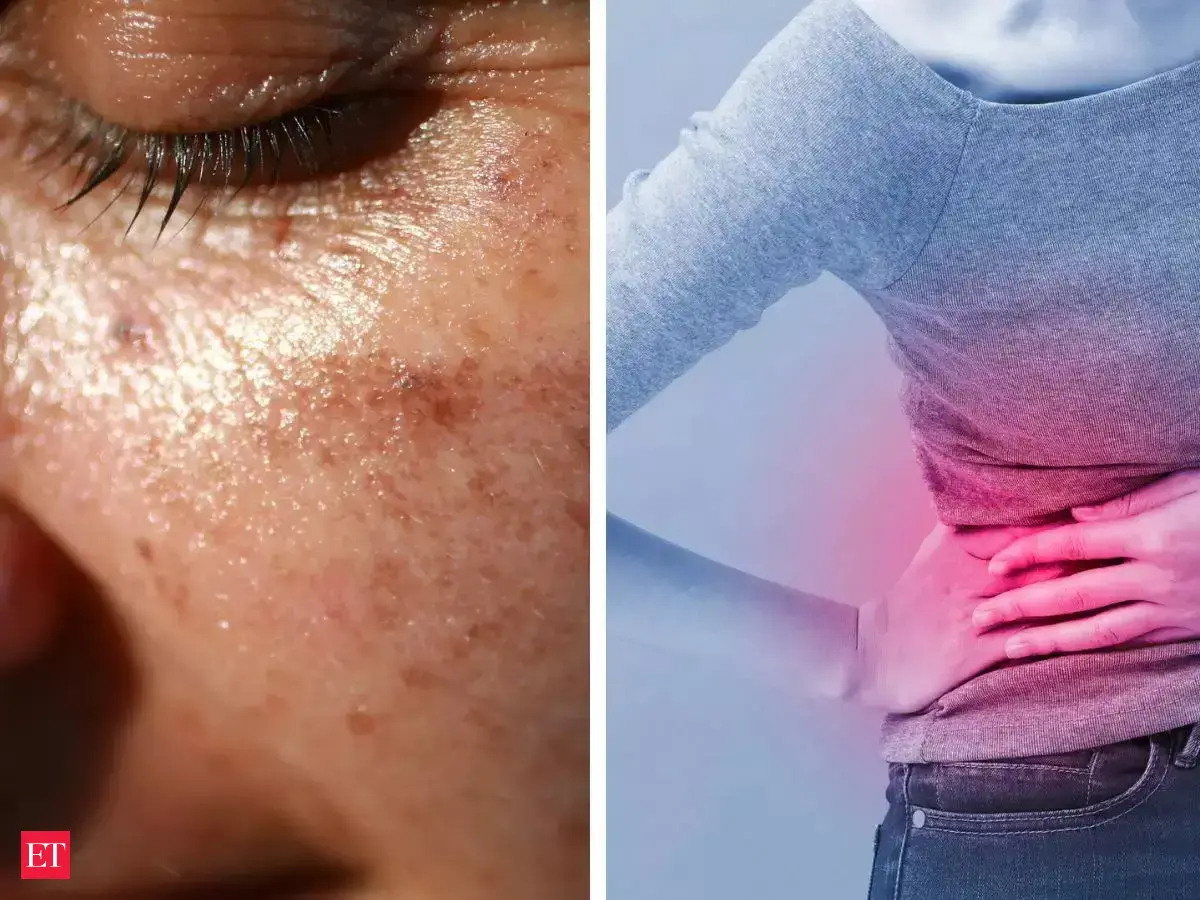 4 skin changes that can signal kidney damage - Skin can flag kidney ...
