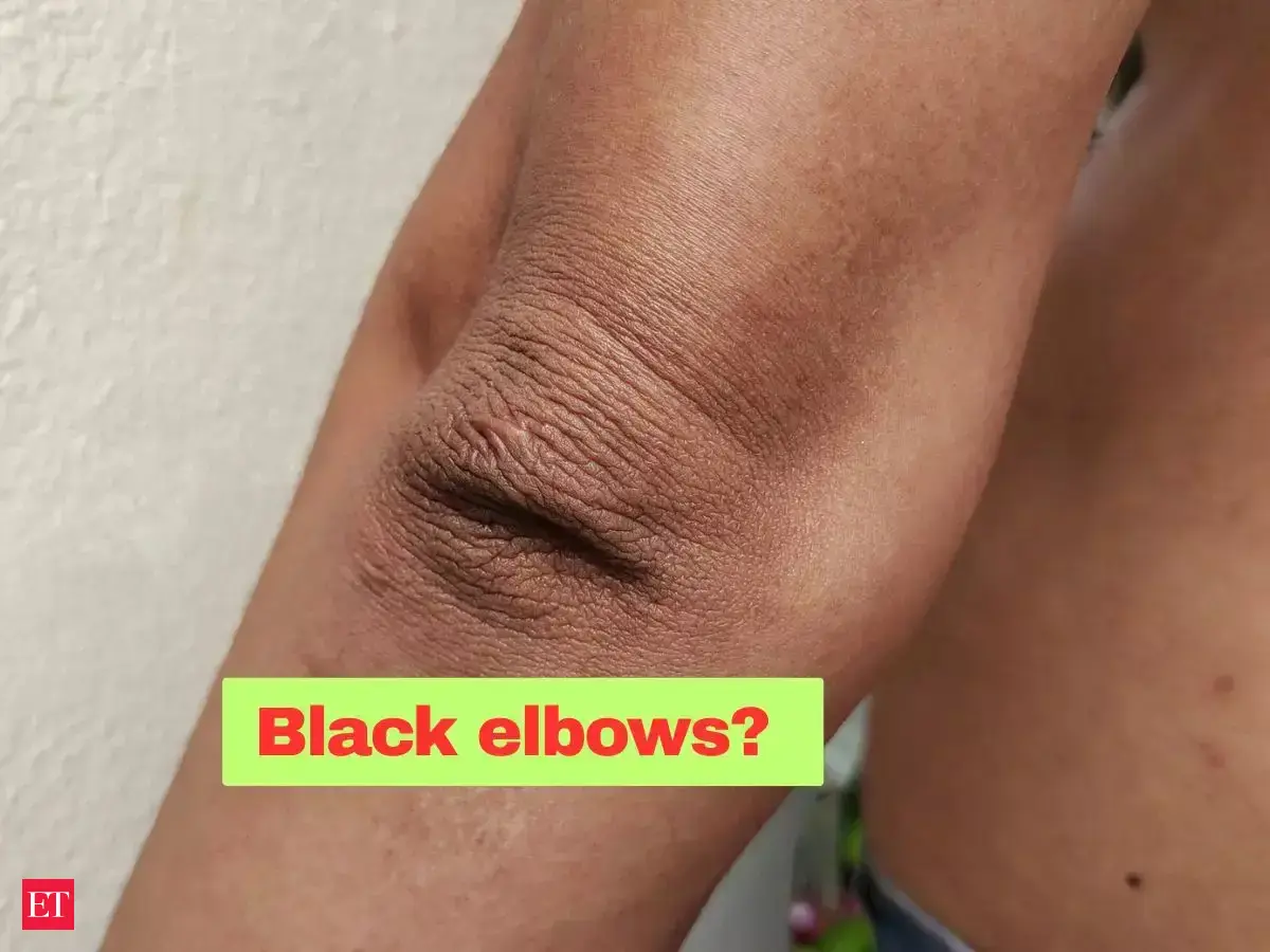 Dark elbows? Dermatologist suggests these 5 steps to remove it easily ...