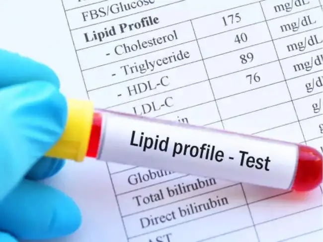 Want an accurate lipid profile test result? Watch what you eat the day ...