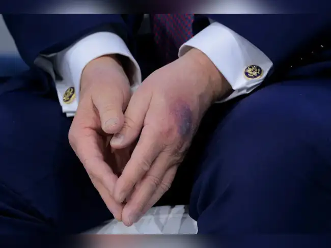 Trump hand bruise explanation: Trump explains his large hand bruise as ...