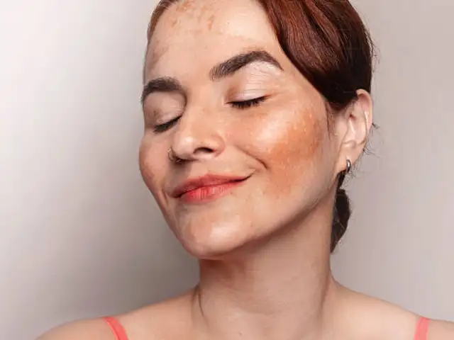 Dark patches or melasma? Dermatologist reveals the real cause behind ...
