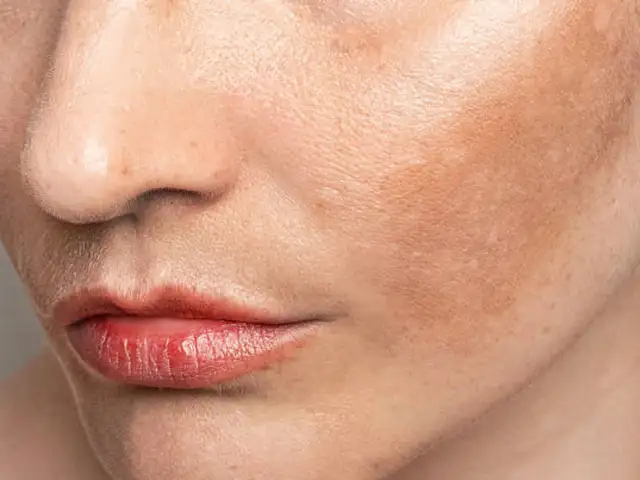 Dark patches or melasma? Dermatologist reveals the real cause behind ...