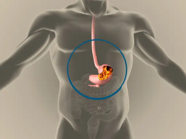 Acidity and heartburn very often? Harvard-trained doctor has 5 easy ...