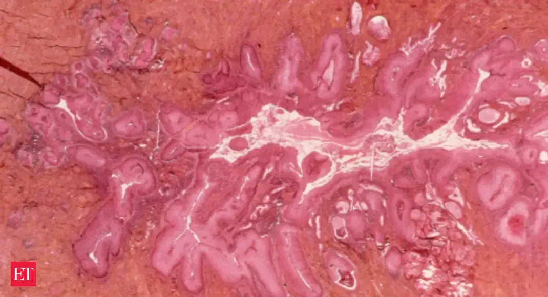 Human Papillomavirus Hpv Testing Could Cut Cervical Cancers By A Third
