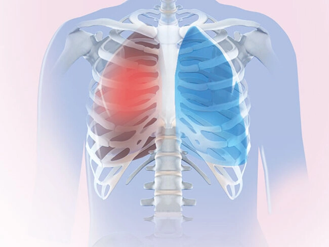 Ibuprofen may lower lung inflammation - The Economic Times
