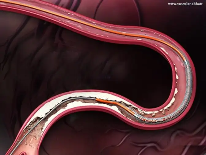 stent price: Pricing regulator says Abbott can discontinue premium ...