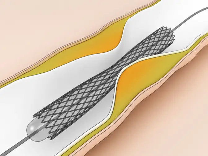 Stent: Domestic stent manufacturer SMT raises Rs 250 crore from Morgan ...