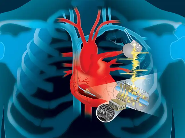 pacemakers: Medical marvel: A new device will use heart's energy to ...