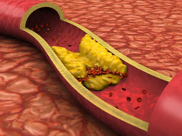 Blood vessel disease - Find out which vegetables help reduce the risk ...