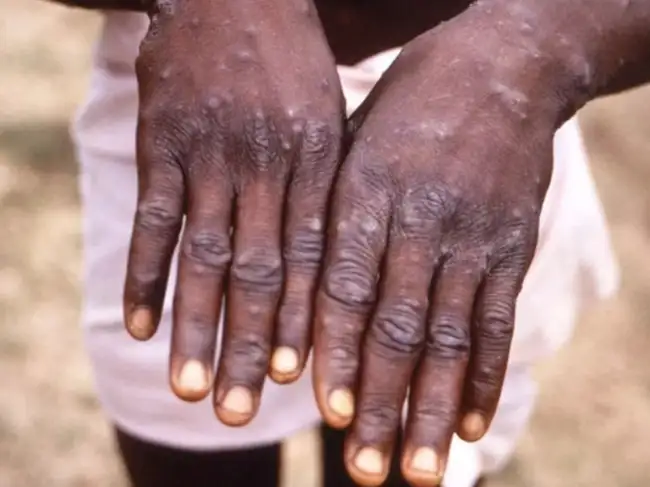 monkeypox: How contagious is monkeypox? Patients can spread the ...