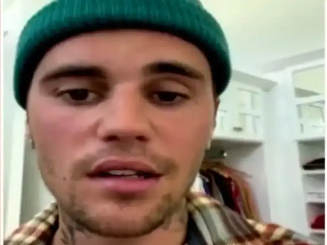 Justin Bieber Facial Paralysis: 'As you can see, this eye is not ...