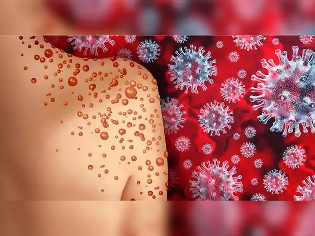 Monkeypox India: Do's, don'ts and types. Read details here