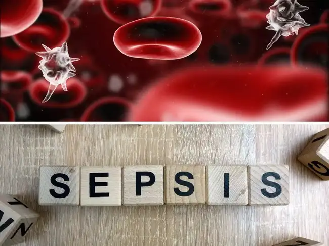 Here's why sepsis can be so deadly, and so expensive to heal from - The ...
