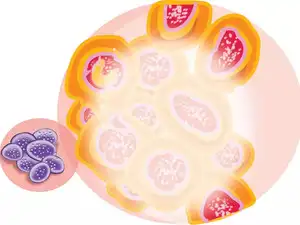 necrotizing fasciitis: Flesh-eating Bacteria: 11-year old boy dies ...