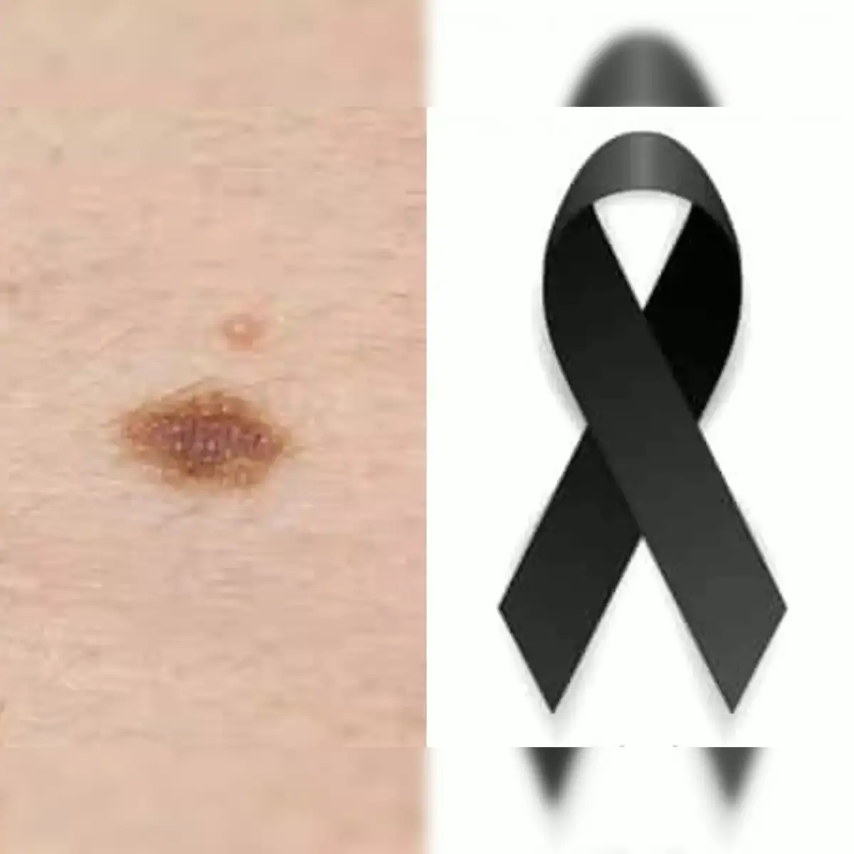 Melanoma Cancer Tattoos