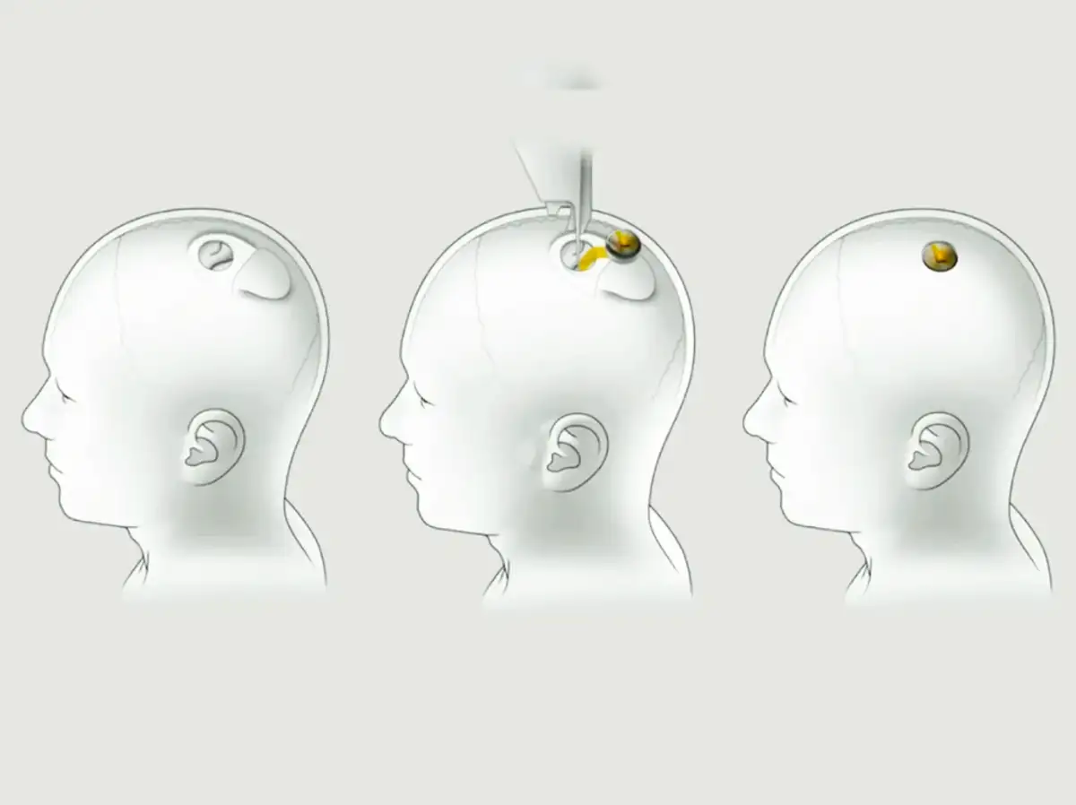Neuralink: China's version of Neuralink unveiled at tech forum - The ...