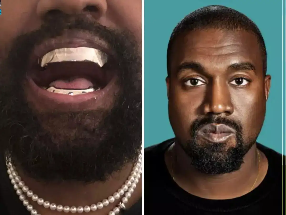 Kanye West Teeth Kanye West Has Replaced His Teeth With TITANIUM 😳